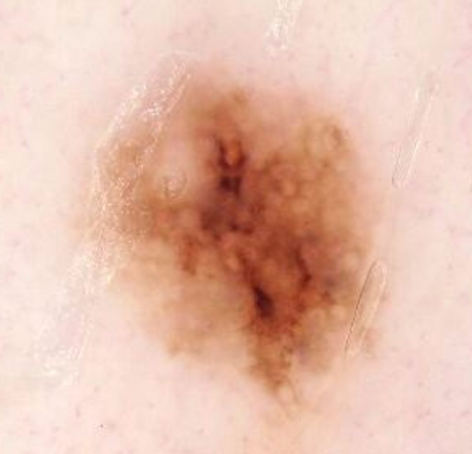 Skin Lesion Classification | Agnieszka Mikołajczyk